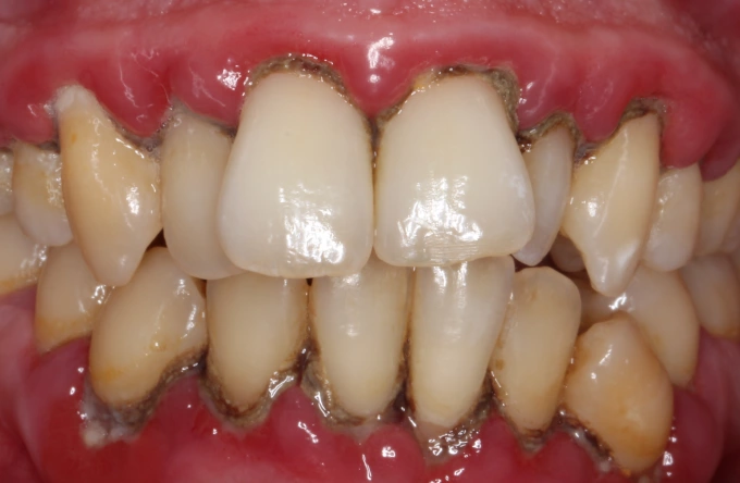 Parodontologie | Apex Tandartsen